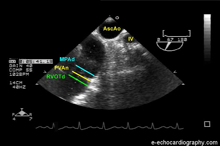 Pulmonary Valve/Artery Anatomy & Function