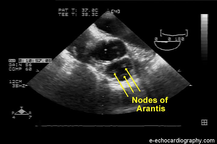 Pulmonary Valve/Artery Anatomy & Function