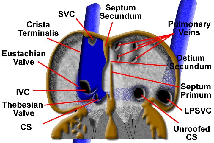 Ostium Secundum Atrial Septal Defect Congenital Heart Disease & GUCH