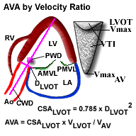 Aortic Valve Area by Velocity Ratio