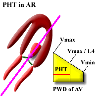 Aortic Regurgitation Pressure Half-Time