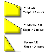 Aortic Regurgitation Decay Slope